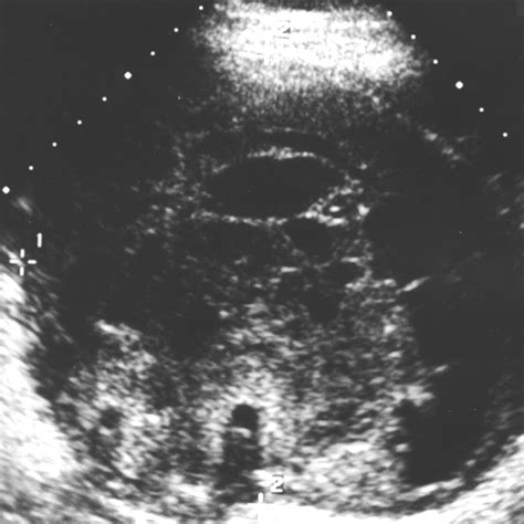 Perigraft Seroma Of Open Aortic Reconstruction Ajr