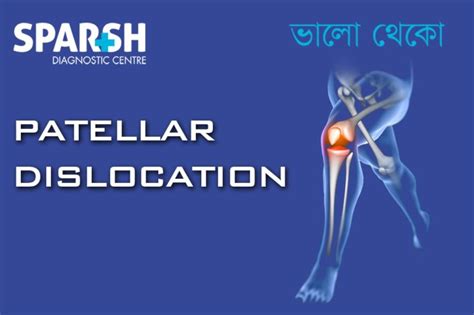 Patellar Dislocation Sparsh Diagnostic Center
