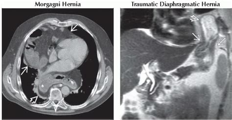 Da2 Db1 Elevatedordeformedhemidiaphragm Ffu4 Abdominal Key
