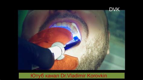 Фиксация циркониевой коронки 26 зуб. - YouTube