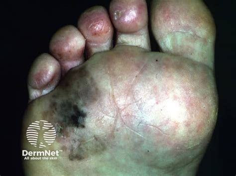 Acral Lentiginous Melanoma Images — Dermnet