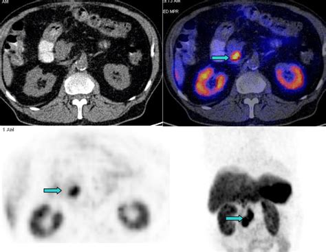 Noticeable 68 Ga Dotatoc Uptake In The Head Of Pancreas Arrows Suv