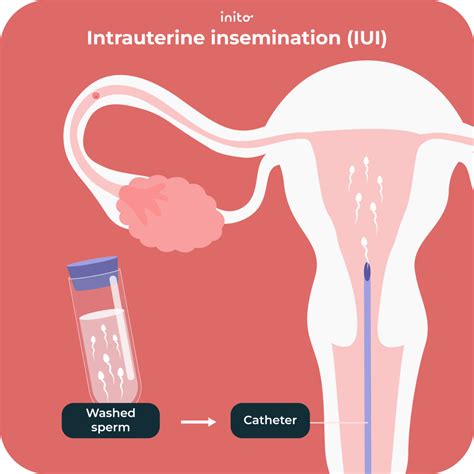 Understanding The Iui Procedure A Complete Overview