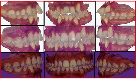 Clear Aligners Reliable Orthodontic Solution For Straighter Teeth