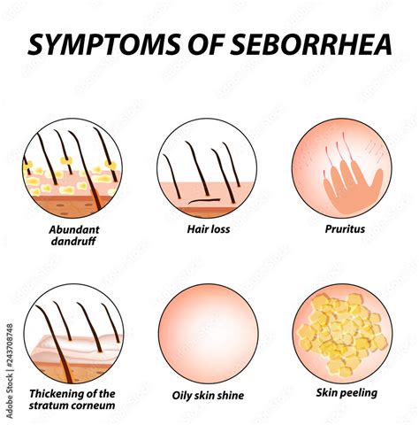 Symptoms Of Seborrhea Seborrhea Skin And Hair Dandruff Seborrheic Dermatitis Baldness Hair