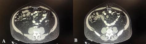 Preoperative Ct Scan In Ft A 6 Cm Size Rectus Diastasis B 3 Cm Size Download Scientific