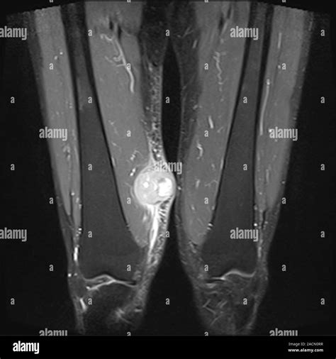Mri Magnetic Resonance Imaging Of A Malignant Tumour Sarcoma On The Right Thigh Of A Male