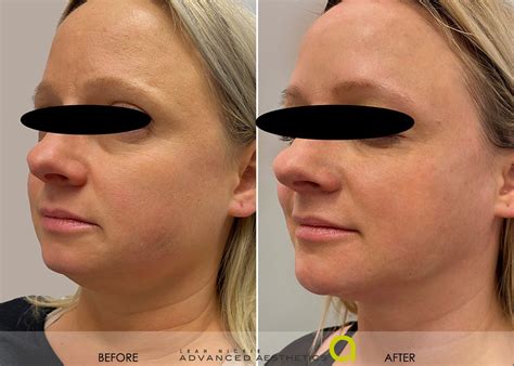 Radiesse Marionette Lines Before After Radiesse Marionette Lines Before After