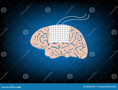 Brain Mapping Surgery Stock Illustrations 18 Brain Mapping Surgery