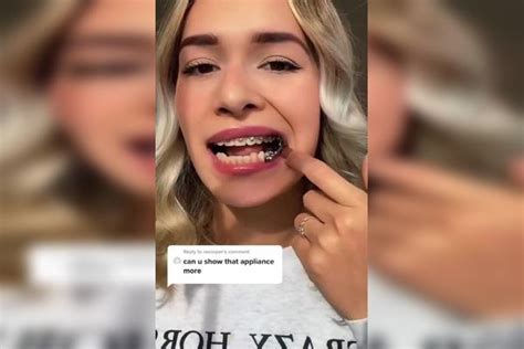 小姐姐佩戴了矫治下颌后缩的矫正器，这嘎吱嘎吱的响声，听着都痛矫治响声姐姐