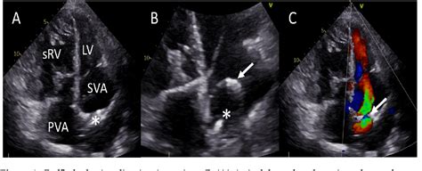 Figure 1 From Contemporary Management Strategies Of Baffle Leaks In