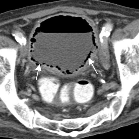Ct Abdomen And Pelvis Axial Section Through The Urinary Bladder Diffuse