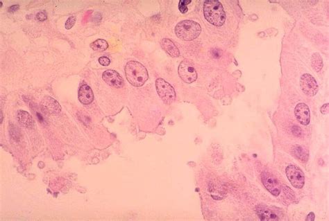 Kostenlose Bild Histopathologie Kryptosporidiose Gallenblase