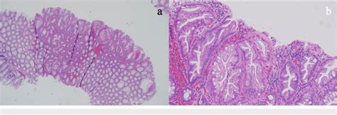 Histologic Appearance Of The Serrated Lesion In The Sigmoid Download Scientific Diagram