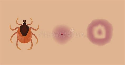 Tick Biting Skin Causing Disease And Erythema Migrans Rash Stock Vector