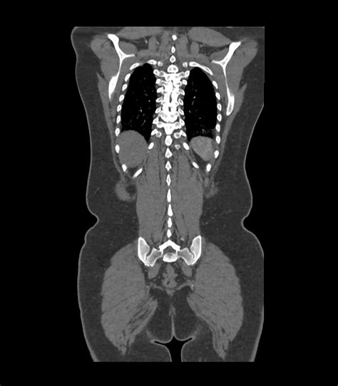 Cervical Aortic Arch With Coarctation And Aneurysms Radiopaedia 44035 47552 C Nc Commons