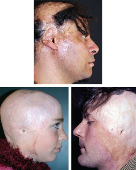 Chapter 10 Auricular Prosthesis Ento Key