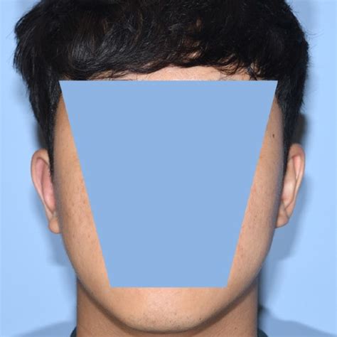 Gallery Ear Surgery Korea Cn