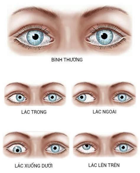 Mắt Lé Là Gì Dấu Hiệu Nhận Biết Và Nguyên Nhân Phòng Khám Đa Khoa