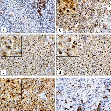 Histiocytic Sarcoma Cytology May Be Monomorphic As In Case 149 A By