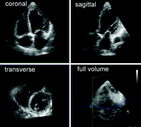 Normal Echocardiogram