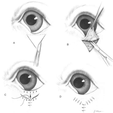 Ectropion Correction Kanhaiyalal Vinodkumari Memorial Eye Hospital