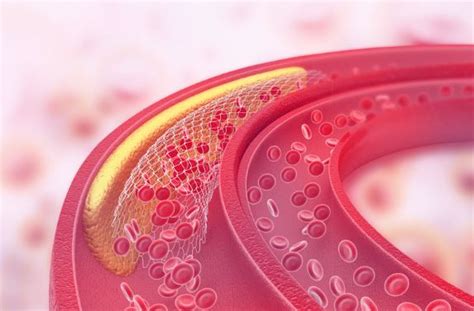 Ptx Therapy Wellspring Clinic