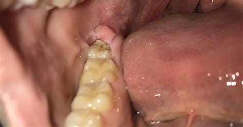 Weird Wisdom Tooth Flap Album On Imgur