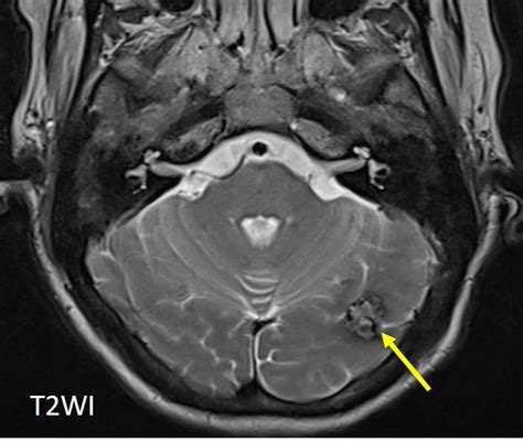 Cavernous Angioma Radiology Cases