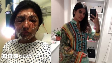 Acid Attack Victim Resham Khan Shares Recovery Photos Bbc News