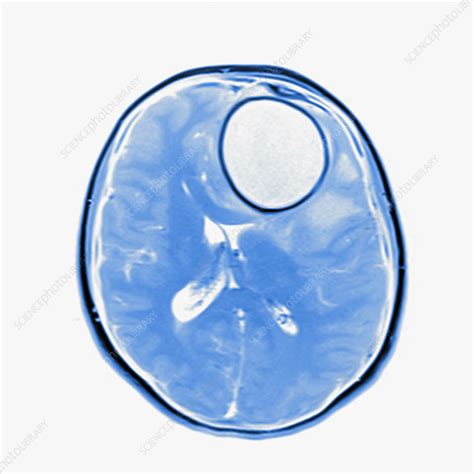 Brain Abscess Mri Sequence Stock Video Clip K0046627 Science