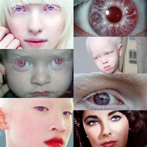 Albino People With Purple Eyes