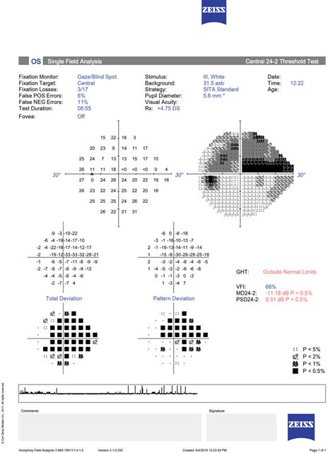 Breaking Down Visual Fields In Glaucoma
