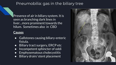 Approach To X Ray Abdomen And Kubpptx