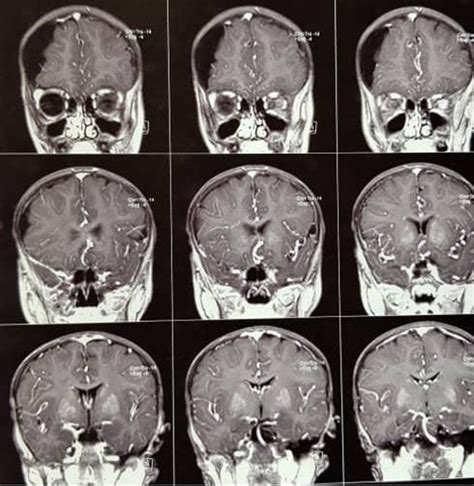 Neurodegenerative Disorder And Diffuse Brain Calcifications Due To