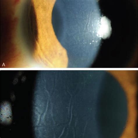 Pdf Interface Fluid Syndrome Induced By Uncontrolled Intraocular