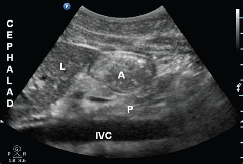 Sonographic Image Of The Gastric Antrum With Solid Content A Antrum Download Scientific