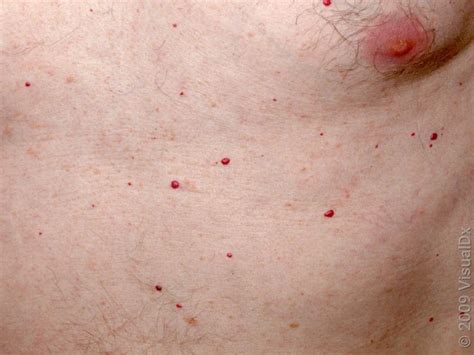 Cherry Angioma Flat Any Natural Treatments For Cherry Angioma Removal