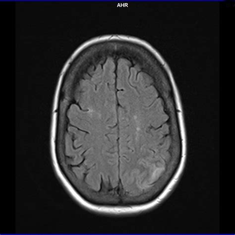 Radiopaedia Case Stroke Id 69554 Study 79498 Nc Commons