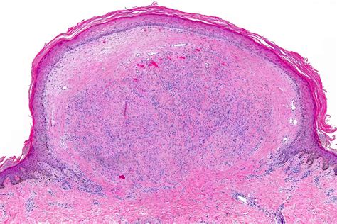 Pyogenic Granuloma Lobular Capillary Hemangioma