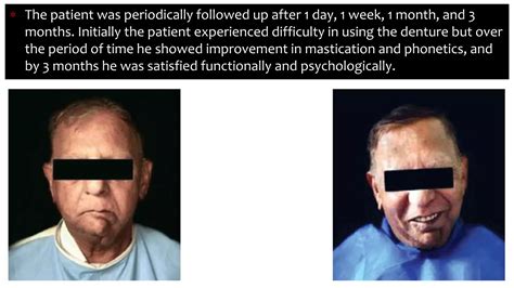Twin Occlusion Prosthesis In A Class 3 Pptx