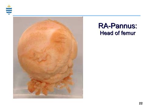 Ppt Pathology Of Arthritis Powerpoint Presentation Free Download