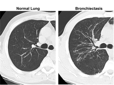 Bronchitis Lung Findings At John Remaley Blog
