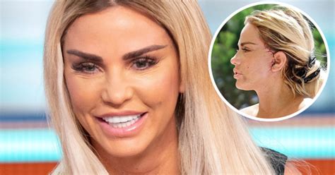 Chuyện bom sex hot nhất nước Anh thẩm mỹ chục lần gây sốc Dây thần kinh bị phá hủy không ai