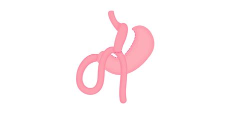 Mini Gastric Bypass Imed Medical