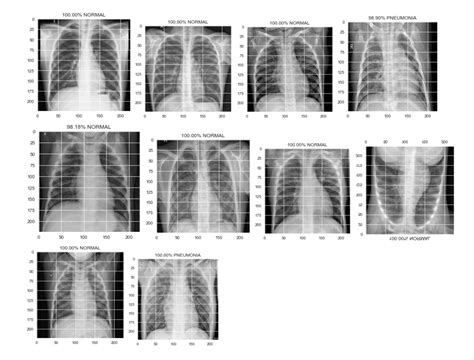 Pneumonia Detection System Based On Chest X Rays Using Inception V Algorithm Saugat Tiwari