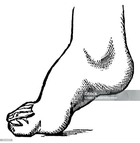 Medical Illustration Of A Human Foot With Talipes 19th Century Stock