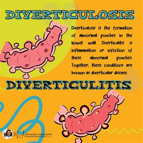 Mazen 🌿 Understanding Diverticulosis And Diverticulitis 🌿 🔍 What Is