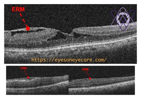 Diagnostic Ophthalmology Oct Perimetry Visualfield Bscan Iolmaster Topography V
