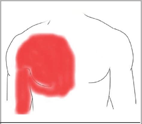 Skin Distribution Of The Right Icbn In Red Download Scientific Diagram
